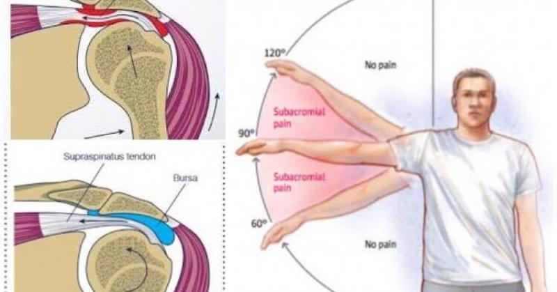 Understanding Impingement Syndrome Causes Symptoms And Treatment